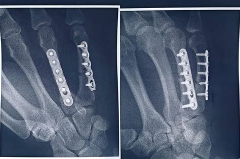 Orif Surgery On My 4th 5th Metacarpals R Radiology