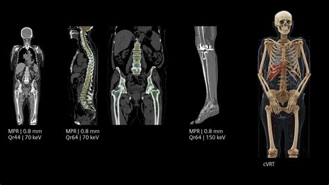 Photon Counting Ct Musculoskeletal Imaging Siemens Healthineers