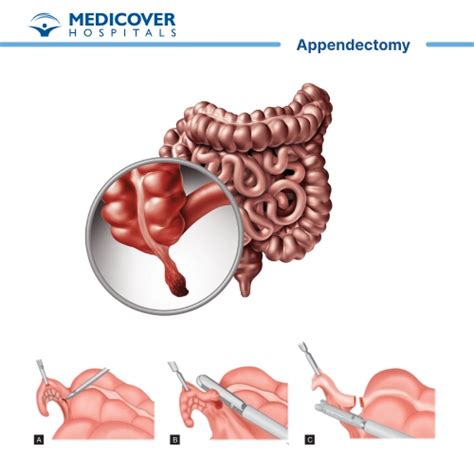 Appendectomy Types Procedures Risks And Recovery