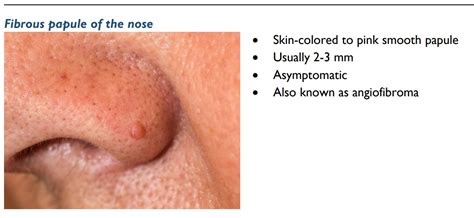 Fibrous Papule Of The Nose Skin Colored To Pink Grepmed