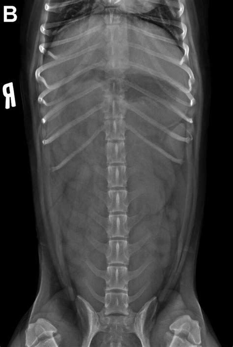 Intussusception X Ray