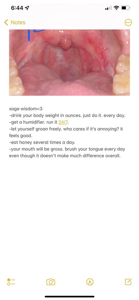 My Tonsillectomy Recovery Daily Photos Included 48 Days Post Op R Tonsilstones