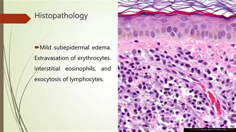 Papular Urticaria Pptx
