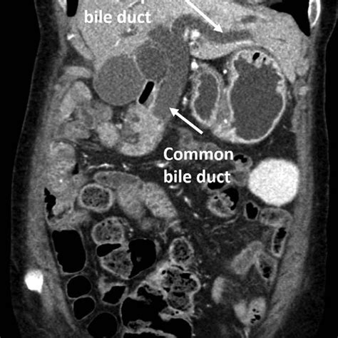 Intraoperative Picture With 2 Of The Splenules Download Scientific