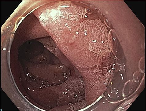 A 30 Mm Sessile Polyp In The Third Portion Of The Duodenum Occupying
