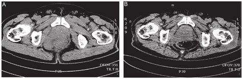 Computed Tomography Ct Scans Prior To And Following Treatment A Ct Download Scientific