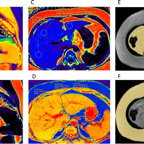 Mri Diagram A Myocardial Native T1 Mapping B Myocardial Proton