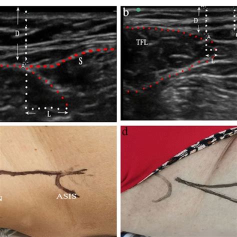 3d Identification Of Lfcn With Doppler Ultrasound Photograph Download