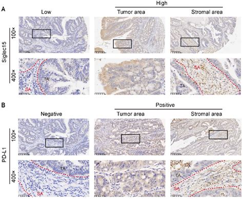 Siglec15 And Pd L1 Expression In Coad Cancer Samples Representative Download Scientific