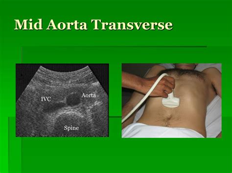 Ppt Emergency Ultrasound Of The Aorta Powerpoint Presentation Free
