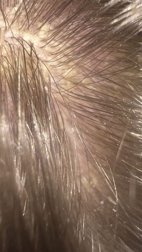 Seb Derm Or Psoriasis Rsebderm