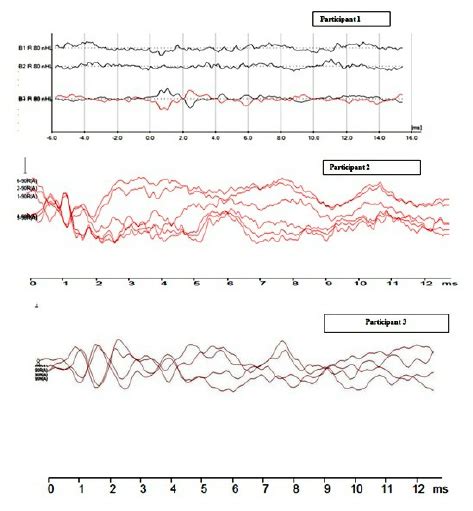 Long Ringing Cochlear Microphonics With Absent Abr Recorded For A Click