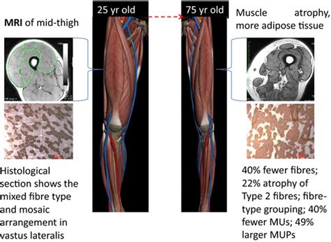 Atrophic Muscles In Older Age Compared With Young A Typical Healthy