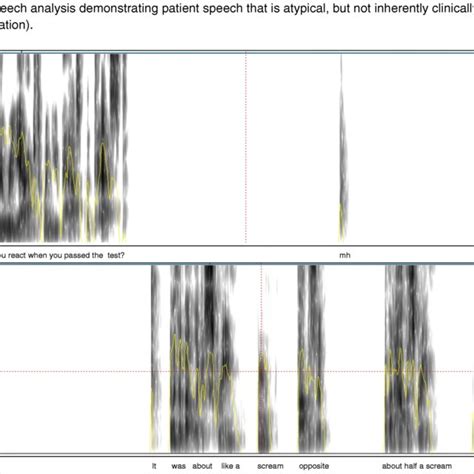 Multimodal Speech Analysis Demonstrating Patient Speech That Is