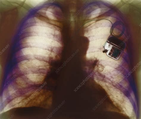 Heart Pacemaker X Ray Stock Image M500 0039 Science Photo Library