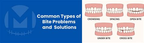 5 Common Types Of Bite Problems And Their Orthodontic Solutions