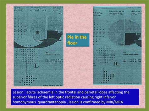 Visual Field Analysis Interpretation Pptx Eye And Vision
