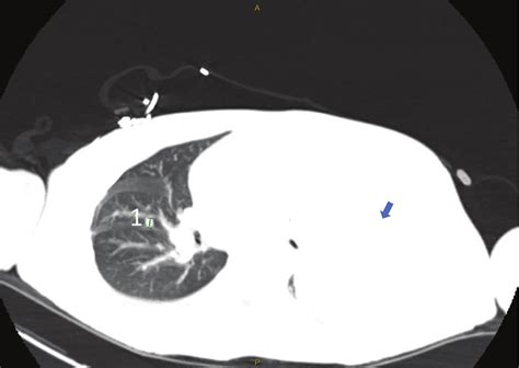 Computed Tomography Scan Of Lung Showing Right Sided Pulmonary Nodule