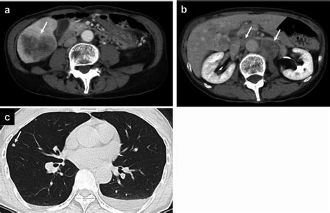 Advanced Intrahepatic Cholangiocarcinoma Successfully Treated With