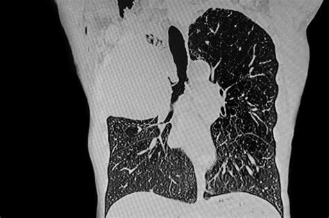 Tomografía Computarizada De Tórax De Cáncer De Pulmón Foto de stock y más banco de imágenes de ...
