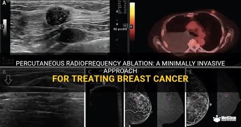 Percutaneous Radiofrequency Ablation A Minimally Invasive Approach For