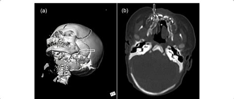 A Presurgical 3d Reconstruction Shows Underdeveloped Mandibular Download Scientific Diagram