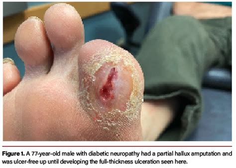 Foot Ulcer On Big Toe Hotsell