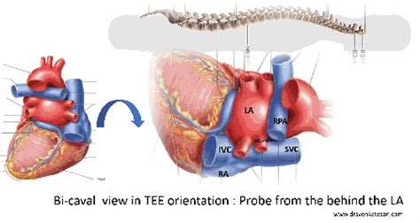 Tee Bicaval View An Anatomical Orientation Drsvenkatesan Md