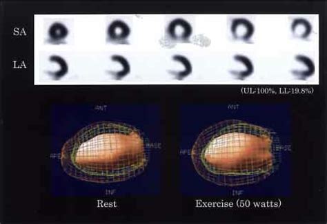 Non Gated Summed Myocardial Perfusion Spect Upper And Left Download Scientific Diagram