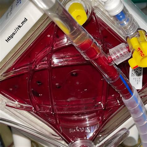 Ecmo Oxygenator Clots Rk Md