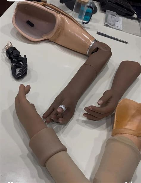 Upper Limb Above Elbow Prosthesis At ₹ 230000piece In New Delhi Id