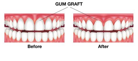 Gum Surgery Dentist Dublin And Pleasanton Ca