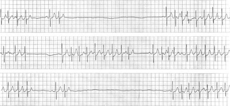 Sinus Node Dysfunction Sick Sinus Syndrome Litfl Ecg Library