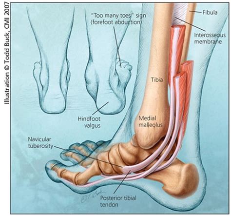 Tibialis Posterior Tendon Anatomy