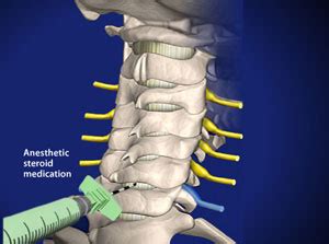 Cervical Epidural Steroid Injection In Plano Frisco Mckinney And Allen