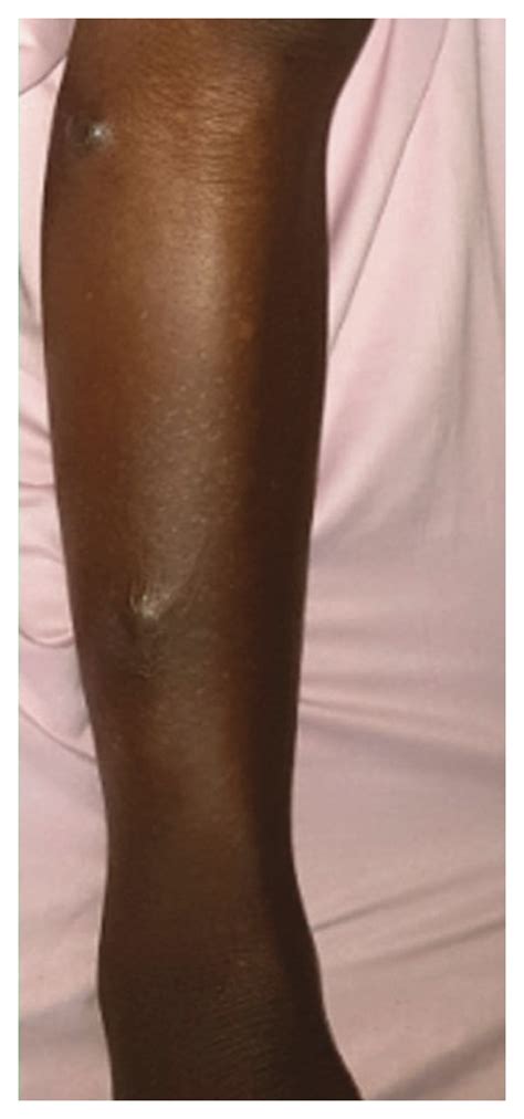 Cutaneous Skip Metastasis Recurrences A Cervical Skip Metastasis In Download Scientific