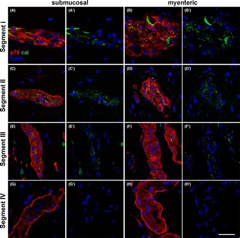 P75 And Calretinin Immunofluorescence Through The Resected Tissue