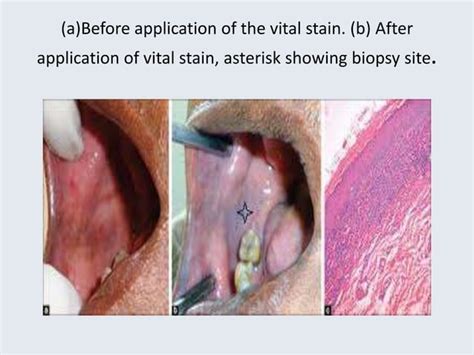 Vital Staining Ppt Notes Pptx