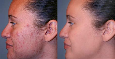 კანი ნებისმიერი სახის გამონაყარისგან თავისუფალი და სუფთა რომ იყოს ისარგებლეთ მარტივი საშინაო