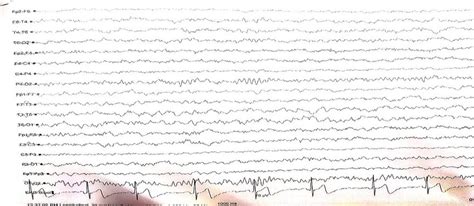 Eeg Longitudinal Bipolar Montage Of A Patient Receiving Cefixime