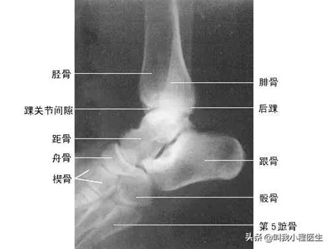 腳後跟長骨刺了怎麼辦？ 每日頭條