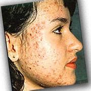 How To Remove Pimple Scars Get Rid Cure And Stop Acne Scarring