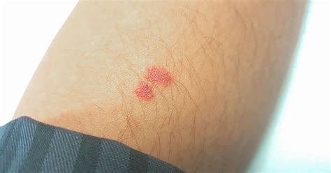 ظهور حبوب دموية على الجلد