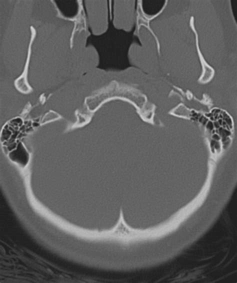 Normal Cervical Spine Mri Including Dixon Radiopaedia 42762 45926