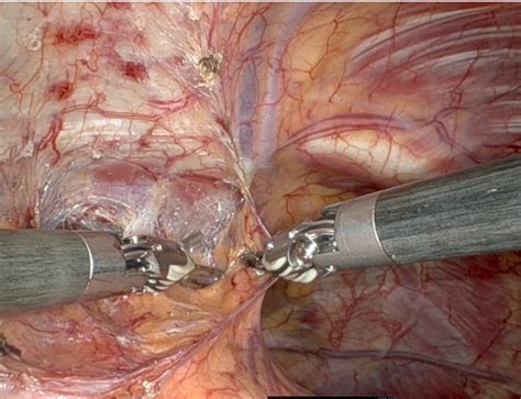 Trans Subxiphoid Robotic Assisted Thymectomy Ctsnet