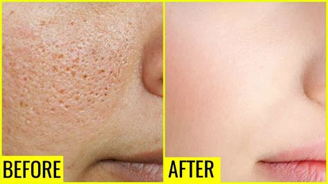 Beautiful Info About How To Get Rid Of Large Pores On Legs Westhoney