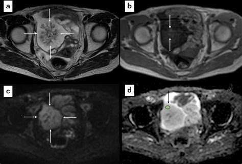 Figure 2 From Low Grade Appendiceal Mucinous Neoplasm With Puffer Ball Like Appearance A Case