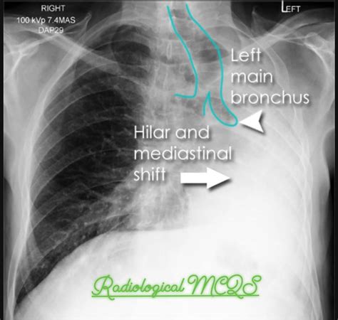 Radiological What Are The Major Findings In Cxr Facebook
