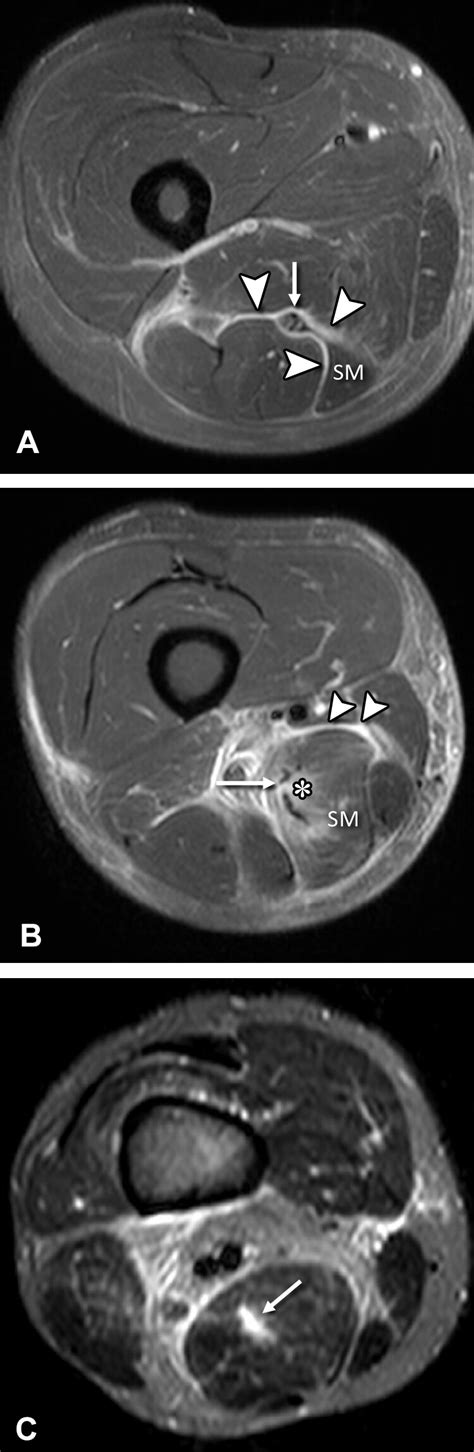 Mri And Us In Hamstring Sports Injury Assessment Anatomy Imaging