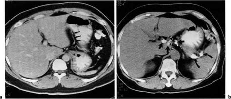 Gastrohepatic Ligament And Hepatoduodenal Ligament Dynamic Radiology